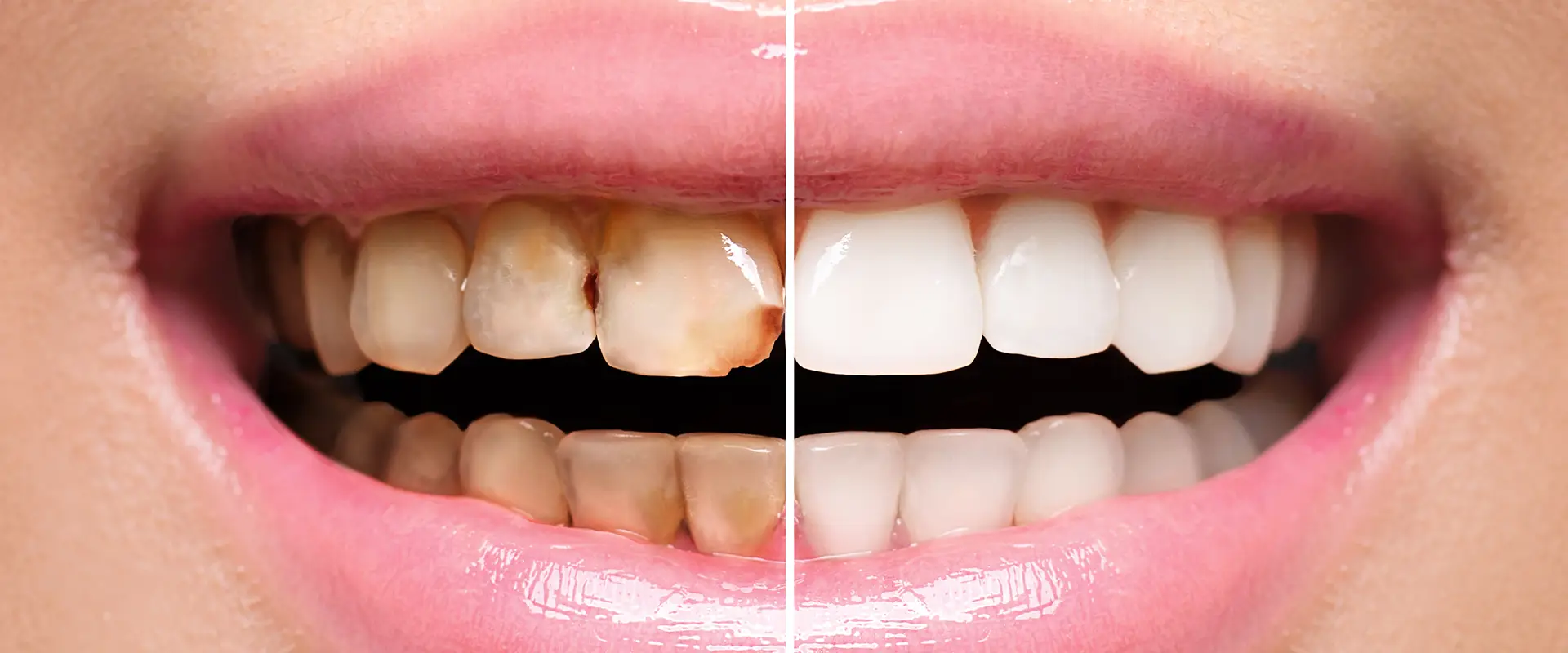 Before & After - Lara Smile Dental Clinic